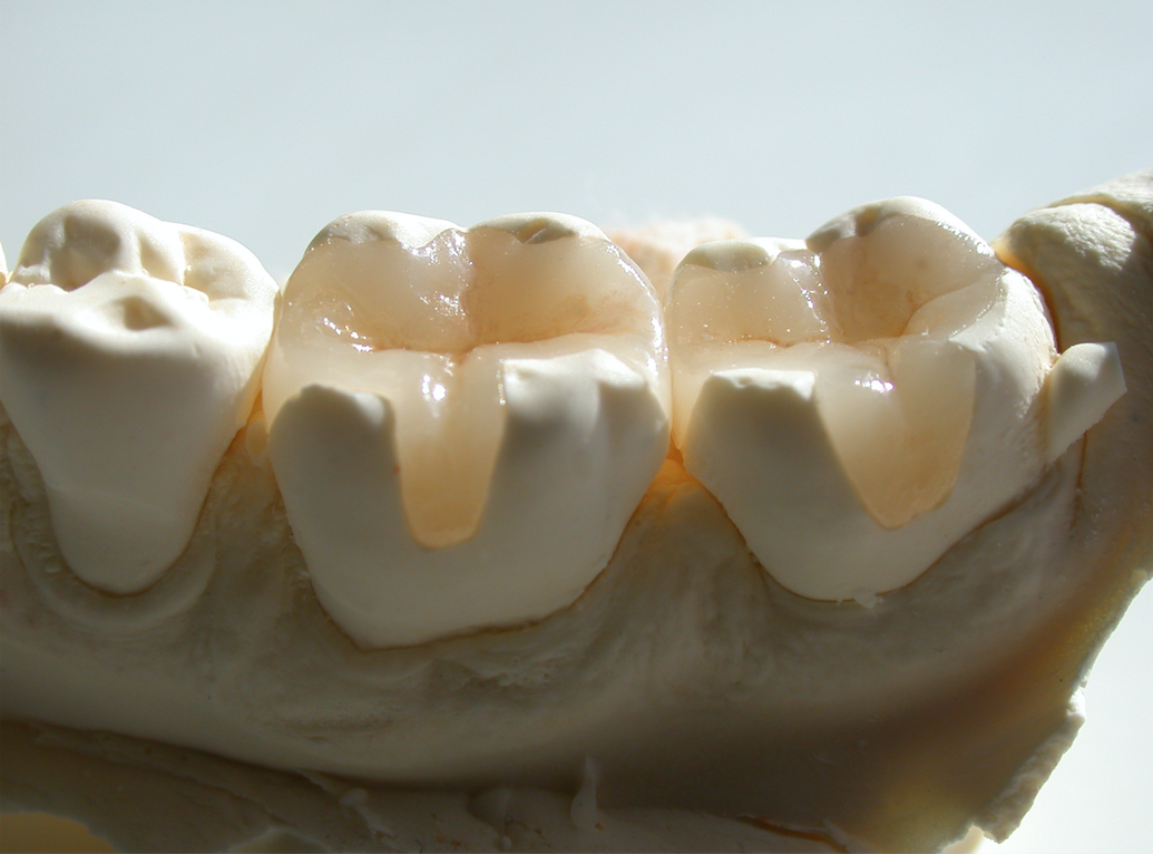 Full ceramic dentures – Dental laboratory Strziga